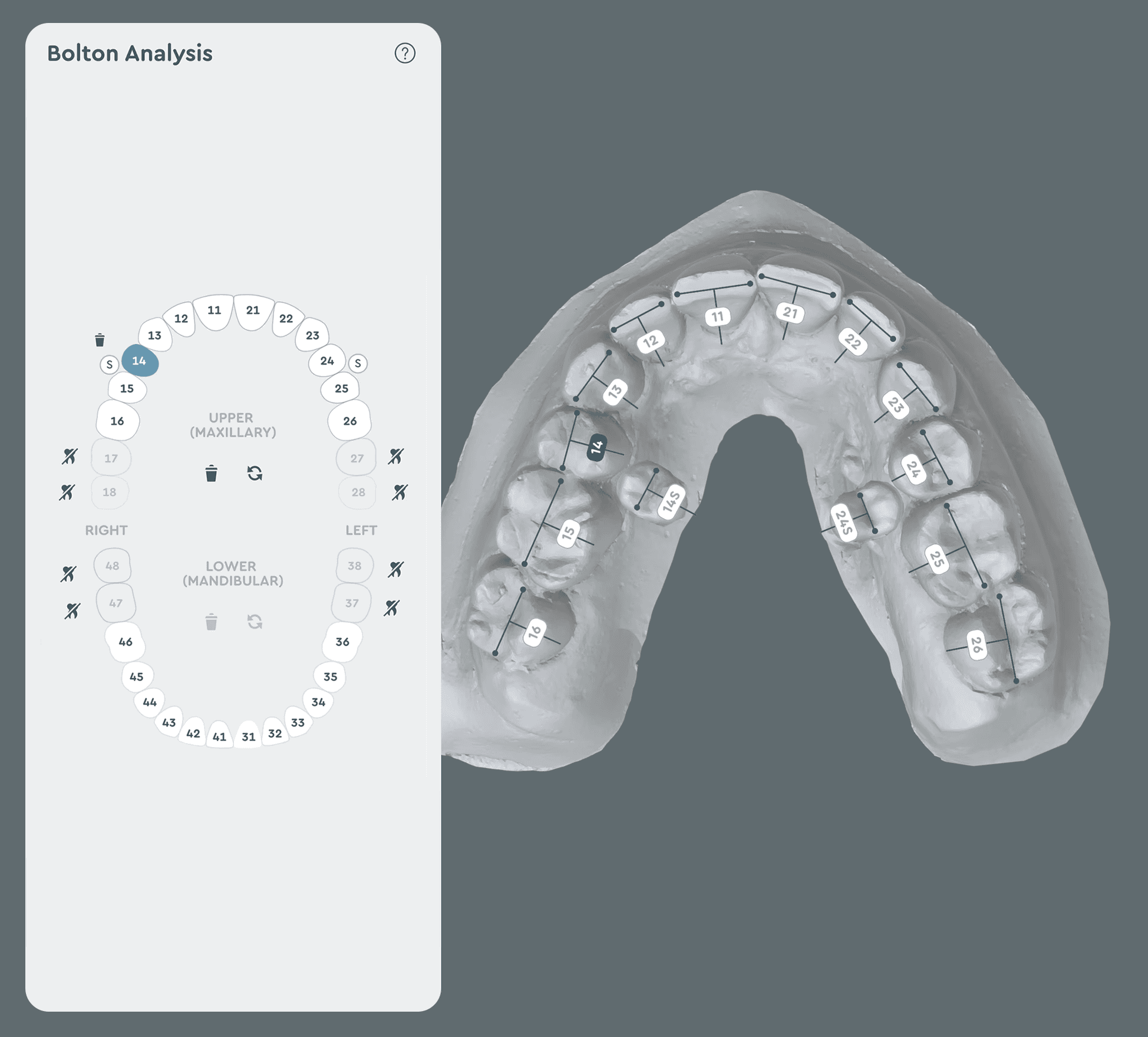 Clear Aligner Design Service | SoftSmile