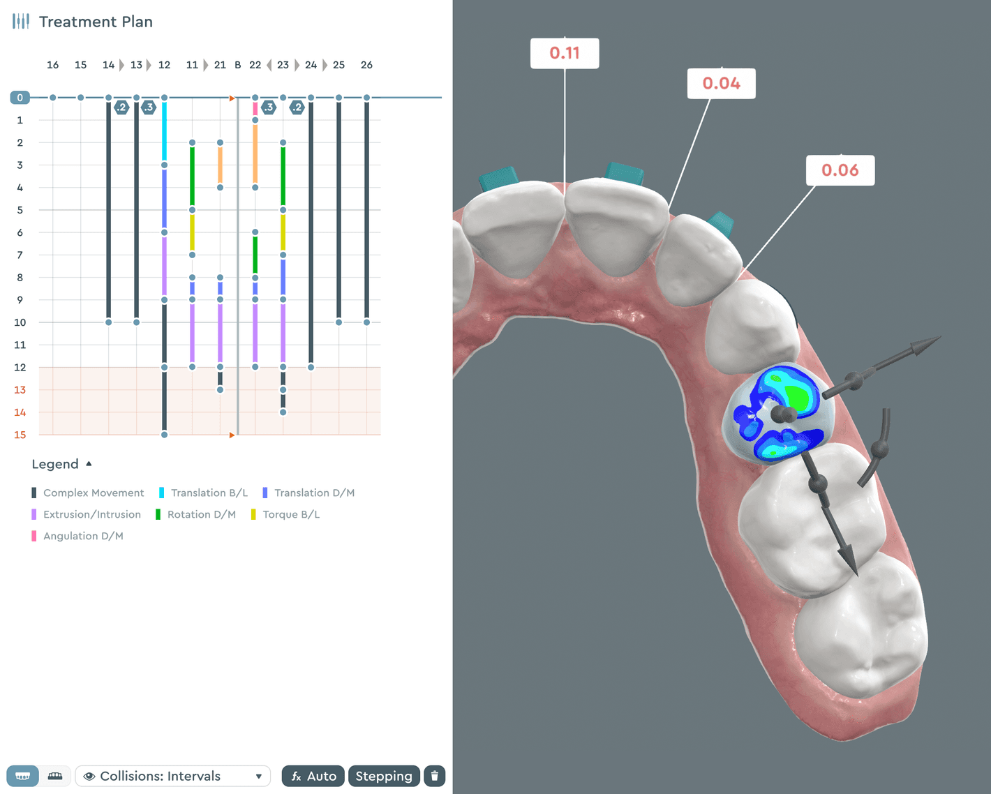 Orthodontic Aligner Design Software — SoftSmile