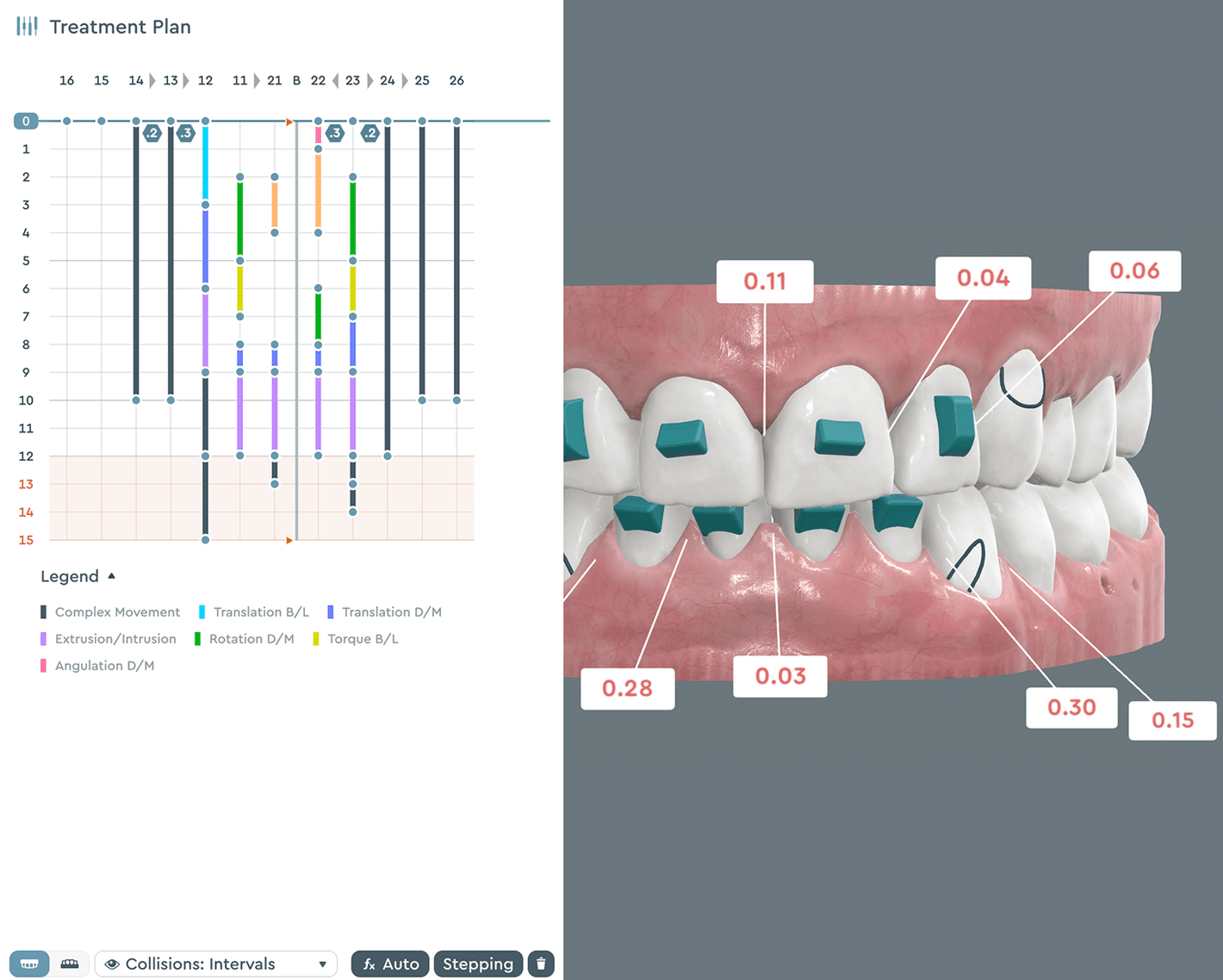Orthodontic Aligner Design Software — SoftSmile