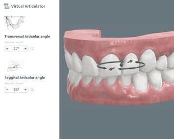 Orthodontic Aligner Design Software — SoftSmile